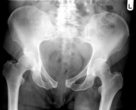 The Pelvis And Hip