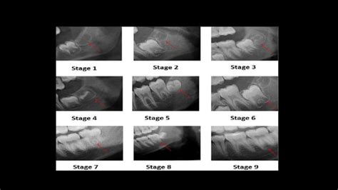 Age Estimation In Forensics Pptx Dental Health Diseases And Conditions
