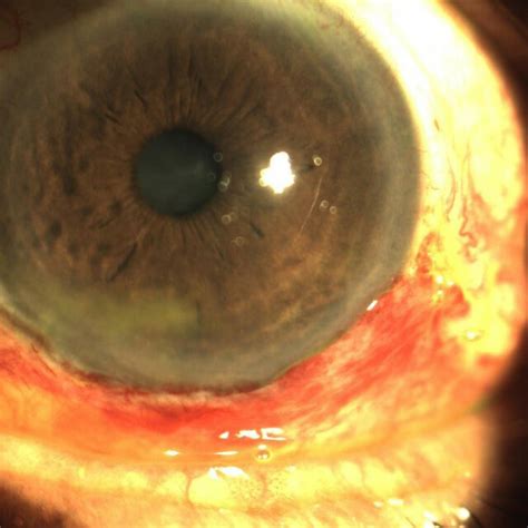 First Post Operative Day Showing Small Corneal Epithelial Defect And Download Scientific