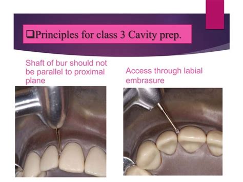 Class Iii Cavity Preparation Pptx Dental Health Diseases And