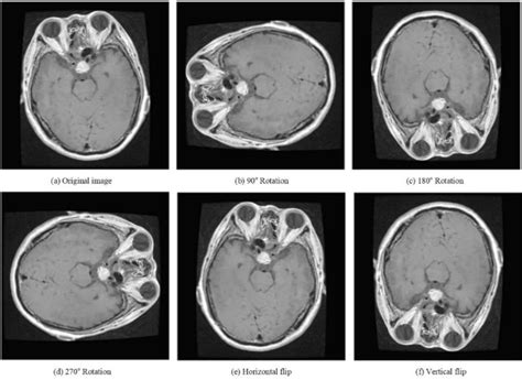 Figure 1 From A Framework For Efficient Brain Tumor Classification
