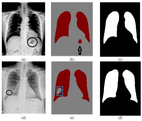 lung field segmentation in chest x ray images using superpixel resizing