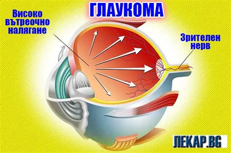 Глаукома. Как точно и къде се лекува? Симптоми и операция - Лекар.БГ