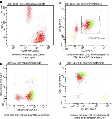 A D Flow Cytometry Interpretation The Neoplastic Cells Display The