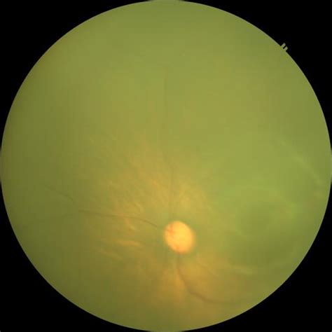 Opticdiskdetection Classification Dataset By Opticdiskdetection