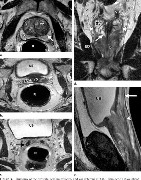 Structure Of Prostatic Utricle Semantic Scholar