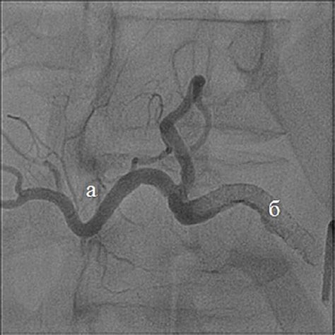 Selective Angiography Of The Common Hepatic Artery After Liver