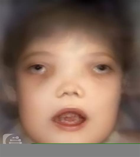 Craniodiaphyseal Dysplasia