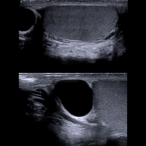 Pediatric Epididymal Cyst Pediatric Radiology Reference Article Pediatric Imaging Pedsimaging