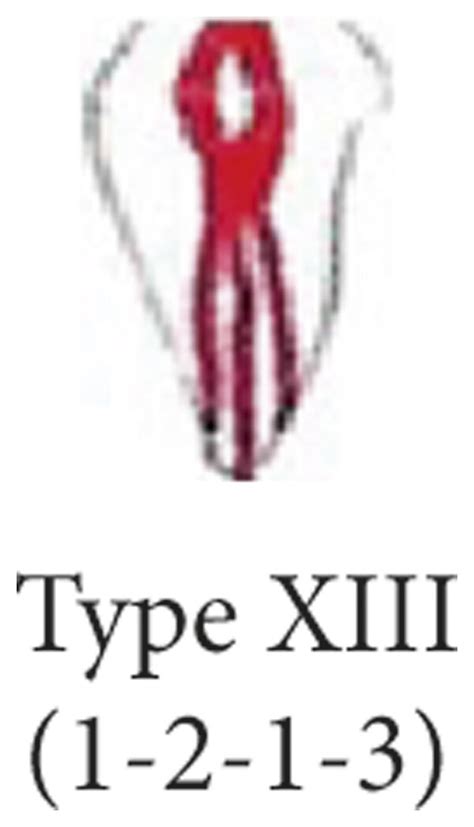 Vertuccis Classification Of Root Canal Morphology From Type I To Type