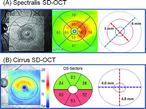 Printout Taken From Spectralis And Cirrus SD OCT A Macular Area Used Download Scientific