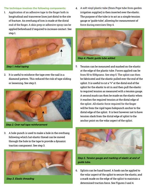 Avulsion Fracture Splint At Kai Chuter Blog