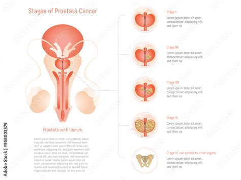 0711cancerdetailed Illustration Depicting The Different Stages Of