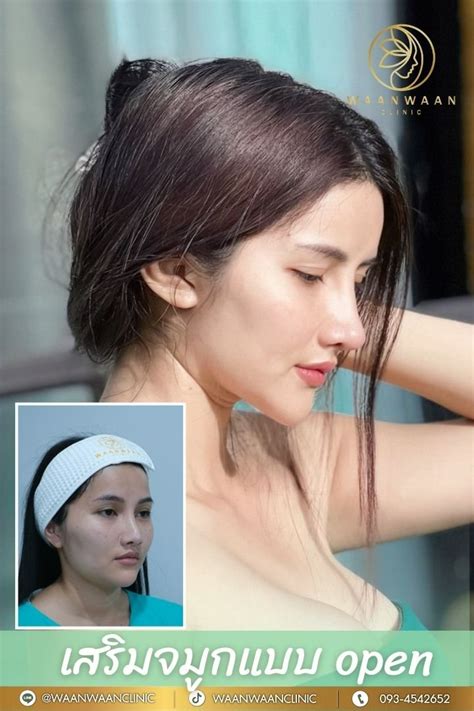 จมูกสวยๆ เทคนิค Open Rhinoplasty ตัดแต่งกระดูกอ่อน และเสริมแกนจมูกเทียมเพื่อยืดปลายจมูก เสริม