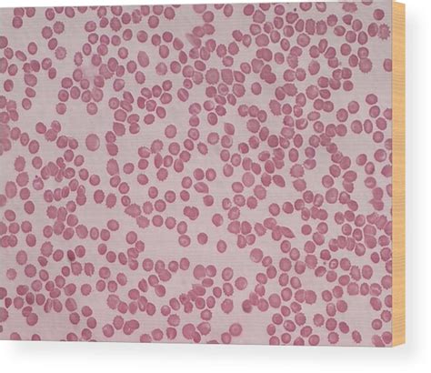 Erythroblastosis Fetalis Cells