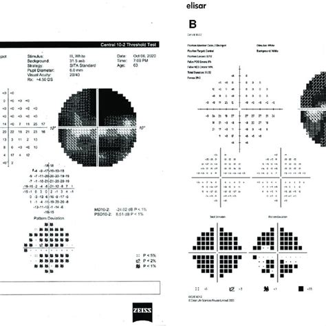 Image Depicting The Visual Field Printout Of Humphrey Field Analyzer Download Scientific