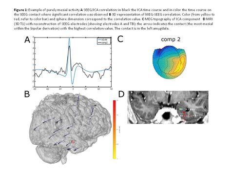 meg can record epileptic spikes from limbic networks an independent