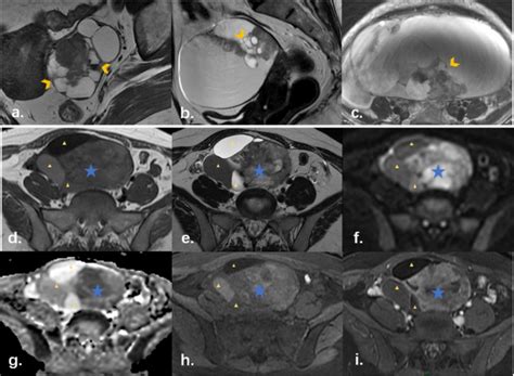 Mri Characteristics Of Figo Stage Ia Epithelial Ovarian Cancer Eoc