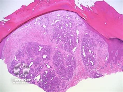 Oral Pyogenic Granuloma Histology Pyogenic Granuloma Lobular