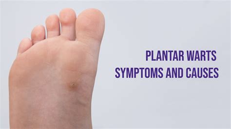 Plantar Warts Symptoms And Causes Wart Wizard