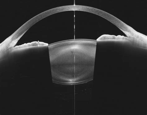 Dream Oct™ Intalight