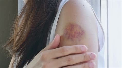 A Woman In A White T Shirt By The Window Touches A Large Bruise On Her