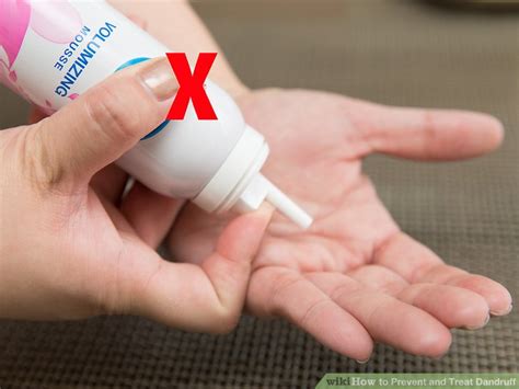 13 Ways To Prevent And Treat Dandruff Wikihow