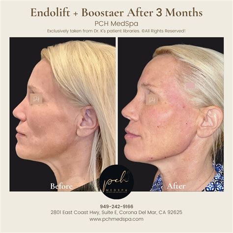 Endolift Face And Neck Before And After Pch Medspa