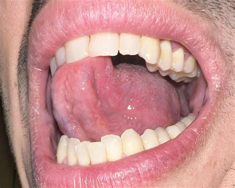 Underneath Tongue Worrying Cancer Photos Attached Raskdentists