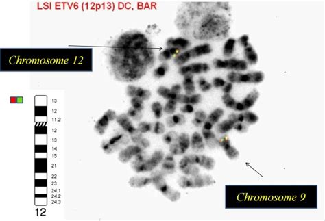 There Was No Evidence Of Etv Rearrangements By Metaphase Fish Download Scientific Diagram