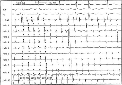 Electrophysiological Determinant For Induction Of Isthmus Dependent Counterclockwise And