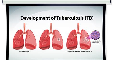 Tuberculosis Lungs Vs Healthy Lungs