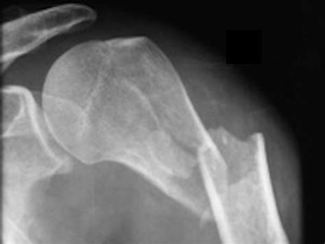 Proximal Humerus Fracture