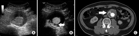 Type Ii Endoleak From A Lumbar Artery Is Shown In A Conventional Download Scientific Diagram