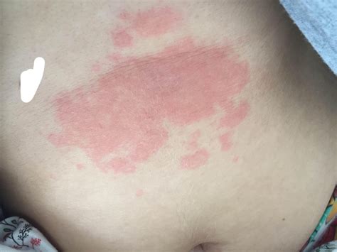 At My Wits End Chronic Urticaria Rurticaria