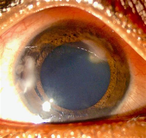 Disciform Keratitis Vs Interstitial Keratitis