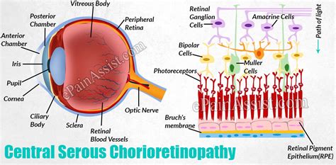 Central Serous Chorioretinopathy Symptoms Who Is At Risk Treatment