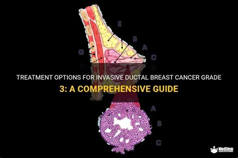 Treatment Options For Invasive Ductal Breast Cancer Grade 3 A
