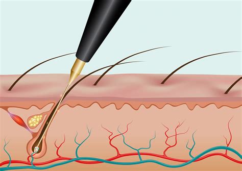 Pro Skin And Beauty Electrolysis Permanent Hair Removal