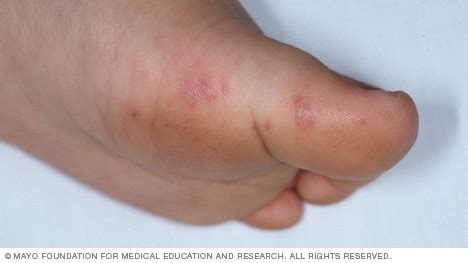 Hand Foot And Mouth Disease On The Foot Mayo Clinic