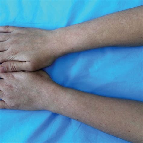 Multiple Hypopigmented Asymptomatic Macules On Both Hands And Forearms