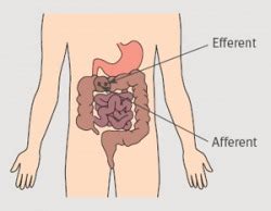 Colostomy Techniques Colostomy Care