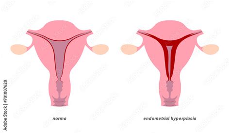 Endometrial Hyperplasia In Uterus Medical Illustration Precancerous
