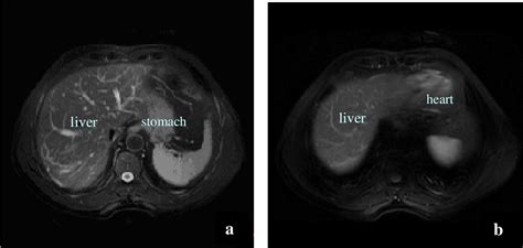 Figure 11 From A Comparative Evaluation For Liver Segmentation From Spir Images And A Novel