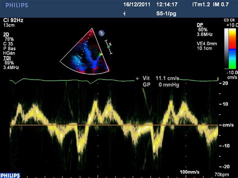 Tapse Echo Calculation At John Bing Blog