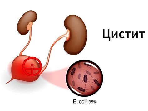 【happy Цистит нь давсагны үрэвсэл бөгөөд ихэвчлэн бактерийн халдвараас үүдэлтэй Эмэгтэйчүүдэд