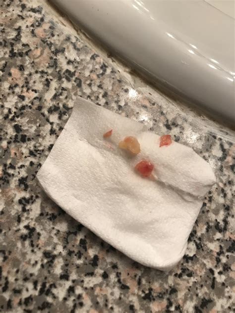 27 Best Rnasalpolyps Images On Pholder Got A Polypectomy And Sinus Surgery January 11th 2021