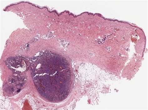 Primary Kaposi Sarcoma Of The Subcutaneous Tissue A Rare Clinical Variant Actas Dermo