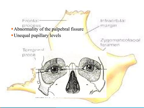 Management Of Zygomaticomaxillary Complex Fractures Ih Pptx