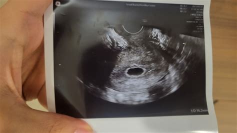 임신 기록 5주 6일차 초음파 아기집 난황 아기 임신확인서 산모수첩 임신부뱃지 받는법 초기임산부 증상기록 네이버 블로그